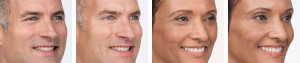 Botox | San Francisco, CA | Dermatology Medical Group of SF